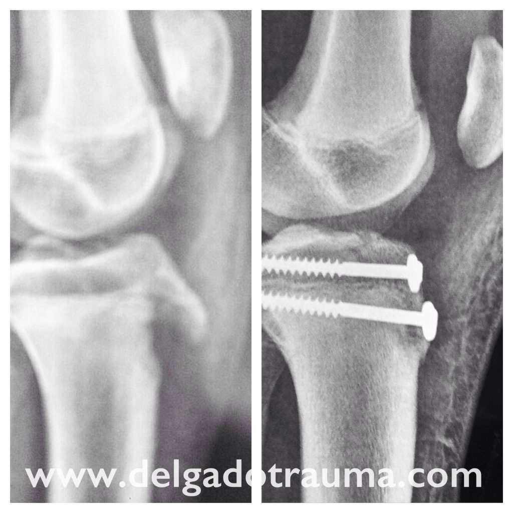 Tratamentos Para Síndrome De Osgood Schlatter - RETOEDU