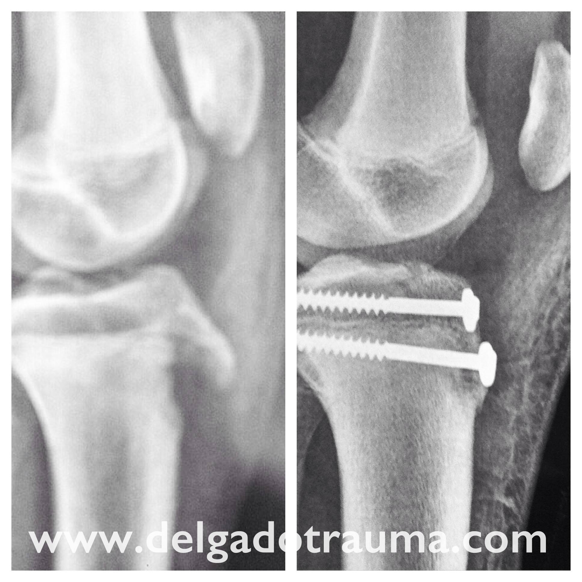 Enfermedad de Osgood-Schlatter Dr. Delgado | DELGADOTRAUMA