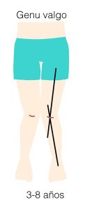 Rodillas del niño: genu valgo / genu varo | DELGADOTRAUMA