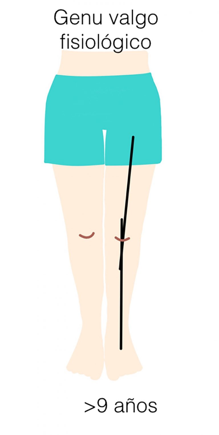 Rodillas del niño: genu valgo / genu varo | DELGADOTRAUMA