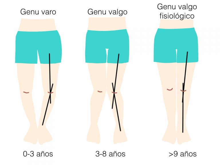Rodillas del niño: genu valgo / genu varo | DELGADOTRAUMA