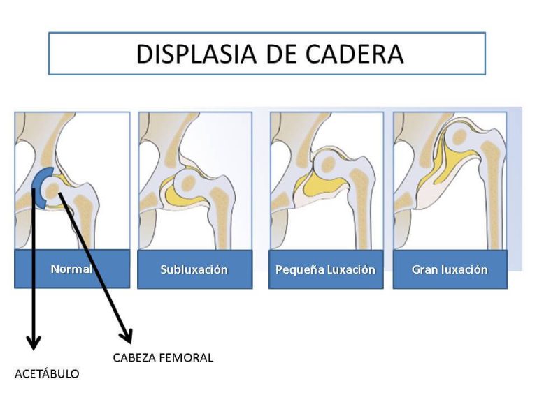 Luxación congénita de caderas Dr. Delgado | DELGADOTRAUMA