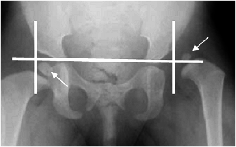 Luxación congénita de caderas Dr. Delgado | DELGADOTRAUMA
