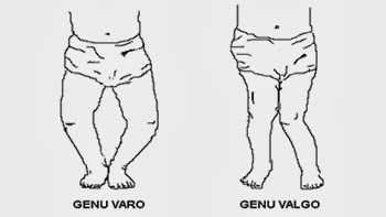 Rodillas del niño: genu valgo / genu varo | DELGADOTRAUMA