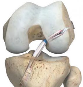 Programa de Rehabilitación para LCA - DELGADOTRAUMA